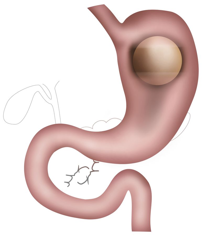 Magenballon | Adipositaszentrum Bern